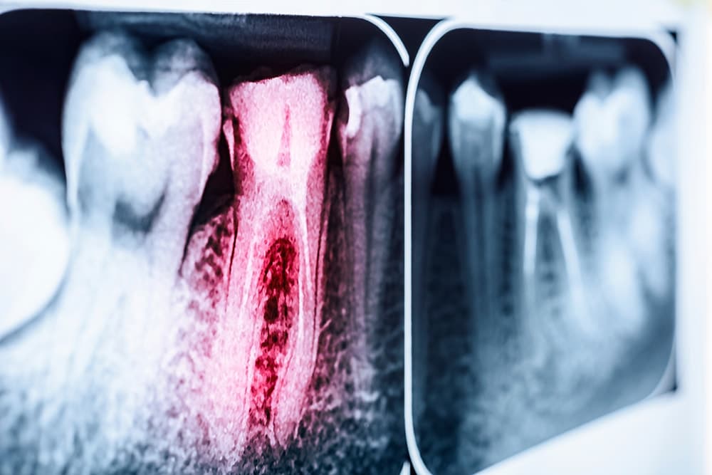How to Save Money on Root Canals and Endodontics | Lower My Dental Bills